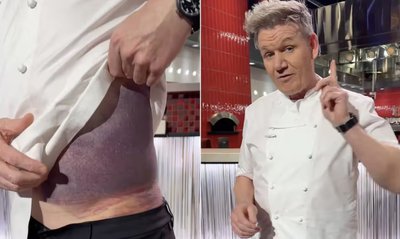 'I am okay' - Chef Gordon Ramsay shows massive purple bruise