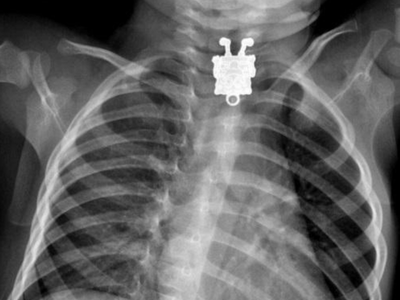 What's the weirdest thing you have accidentally swallowed?