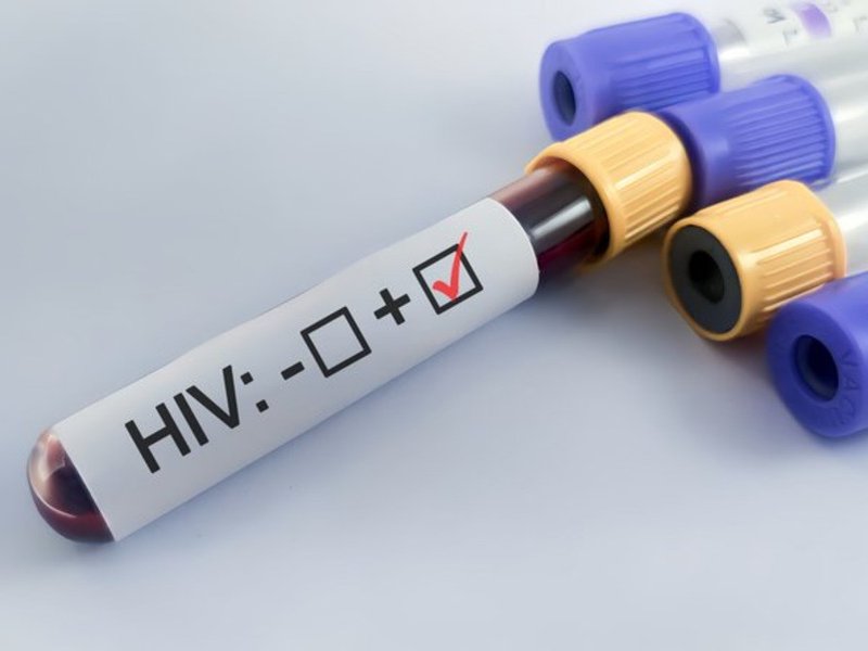 ‘Promising results’ for Durban trial to find HIV cure