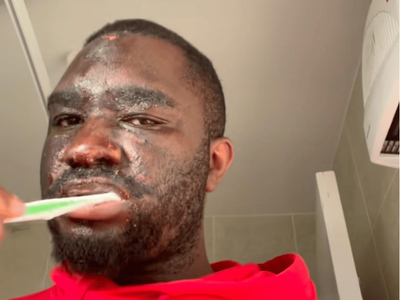 Pressure cooker explosion leaves man with severe burns