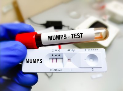 Mumps outbreak: Symptoms to look out for