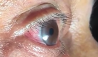 An eyesore! Doctor carefully removes parasitic worm from man's eye