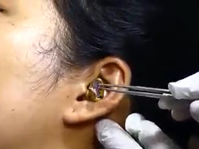 REAL/FAKE: Viral video of surgeon trying to remove snake from woman's ear!