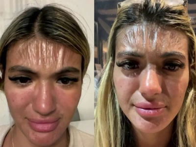 She fell asleep in the sun for 30min and woke up with plastic-like ...