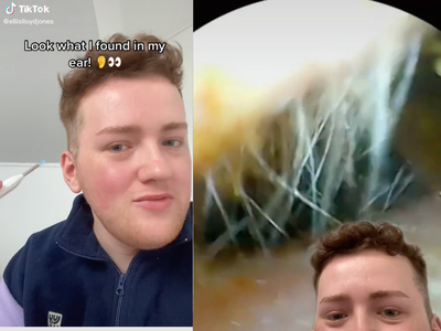 Shocking discovery of mystery object lodged inside this human's ear