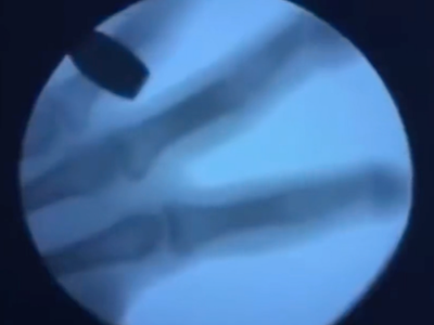 Video shows what cracking knuckles looks like