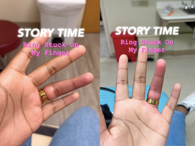 VIDEO: Ring gets stuck on woman's finger for 14 whole hours